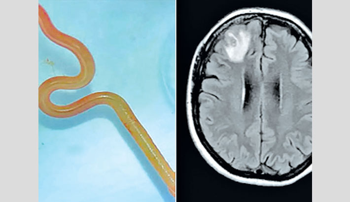 Live worm found in woman's brain in world-first discovery