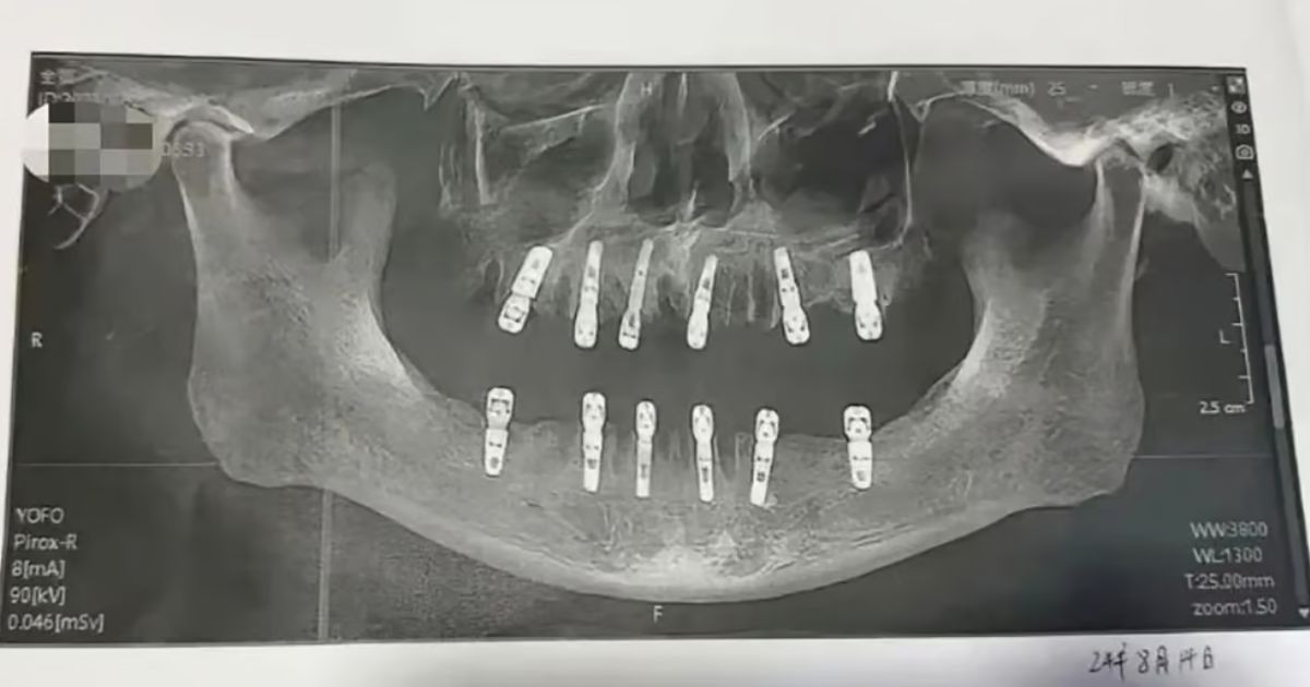 Chinese man dies after having 23 teeth extracted, 12 implants placed in ...